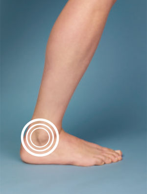 Tobillo-Pie. Síntomas, causas y tratamientos de Tobillo-Pie | Doctuo