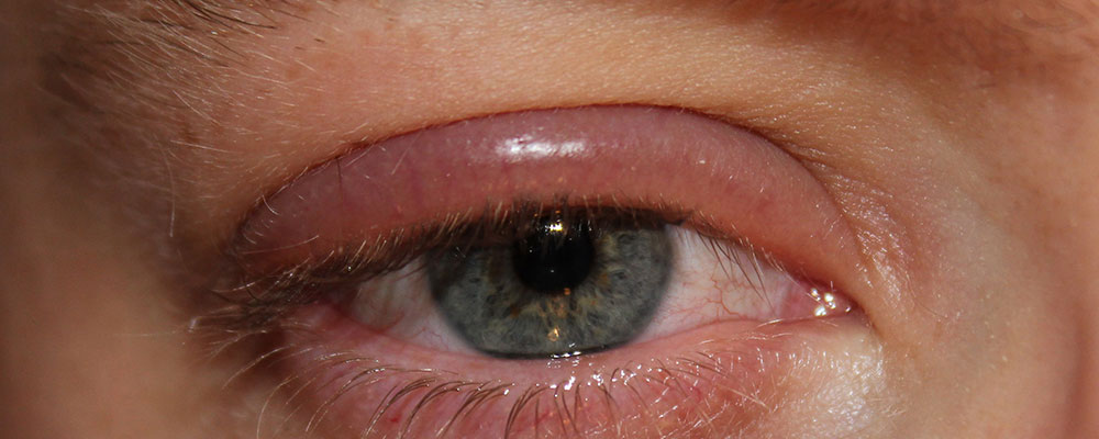 Blefaritis. Síntomas, causas y tratamientos de Blefaritis | Doctuo