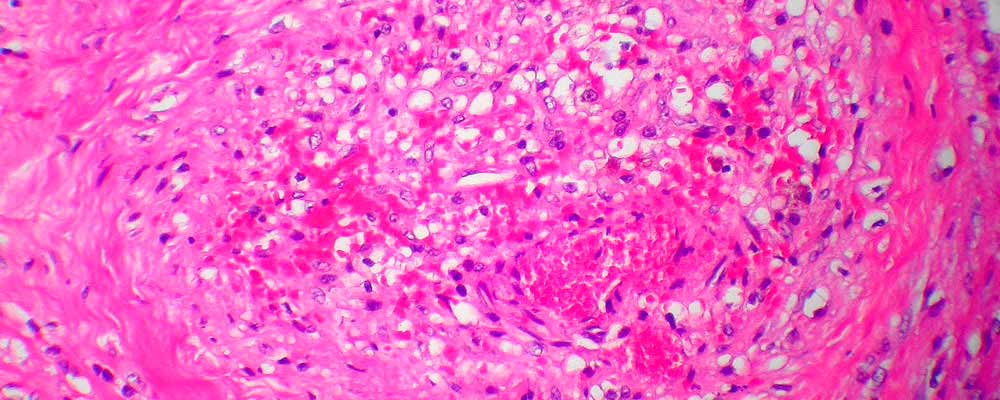 Embolia pulmonar (coágulo de sangre en el pulmón). Síntomas, causas y ...