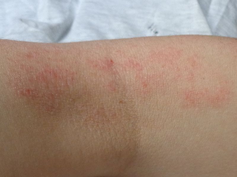 Dermatitis atópica. Síntomas, causas y tratamientos de Dermatitis ...
