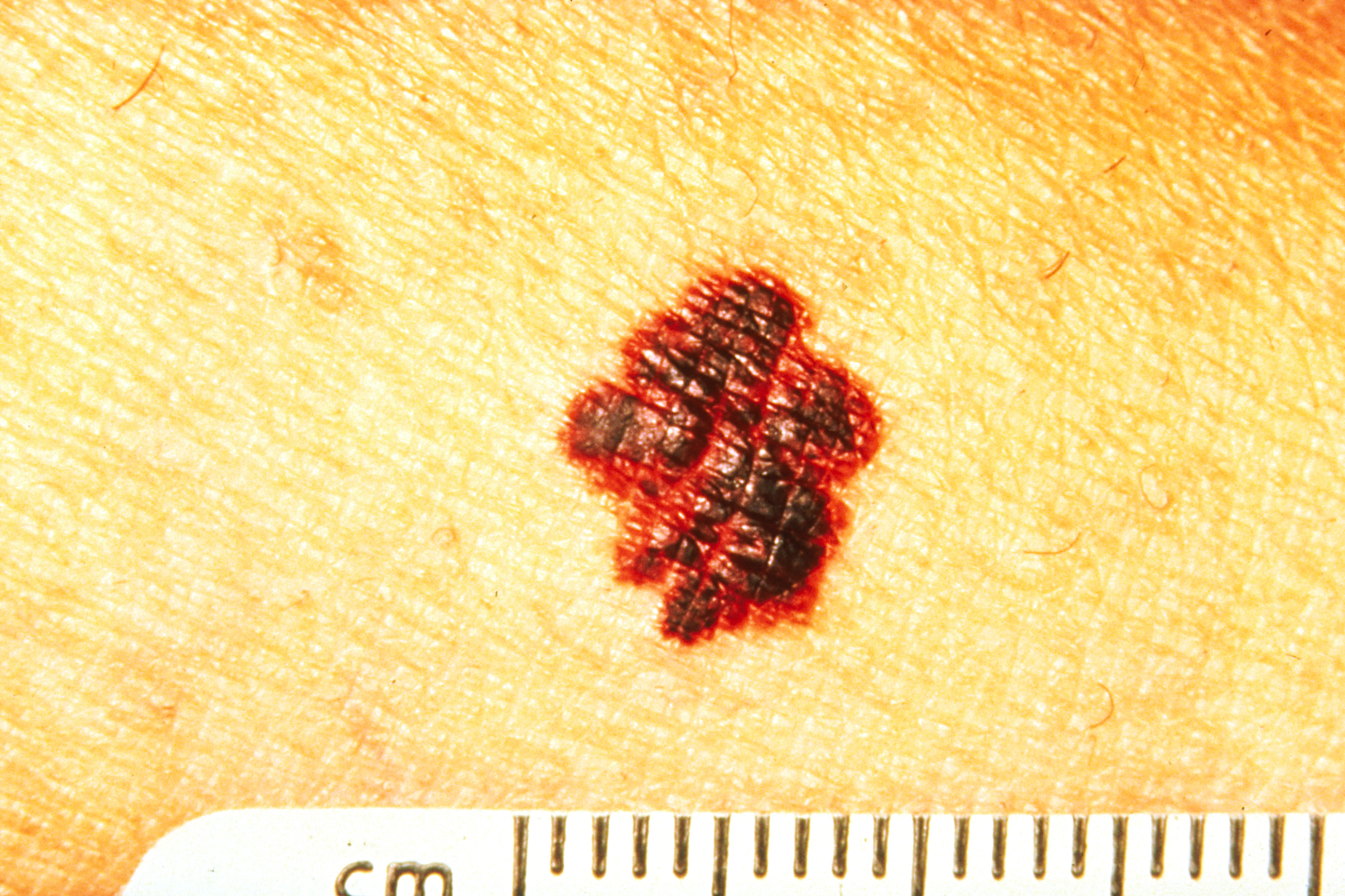 Melanoma. Síntomas, causas y tratamientos de Melanoma | Doctuo