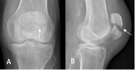 Fractura de rodilla | Doctuo