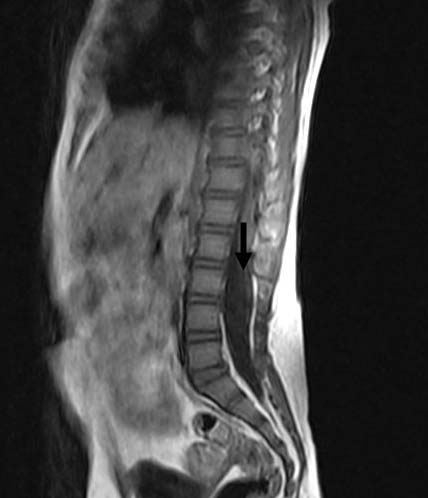 Médula anclada. Síntomas, causas y tratamientos de Médula anclada | Doctuo
