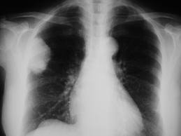 Tumores Torácicos. Síntomas, causas y tratamientos de Tumores Torácicos ...