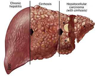 Enfermedad hepática crónica. Síntomas, causas y tratamientos de Enfermedad hepática crónica | Doctuo