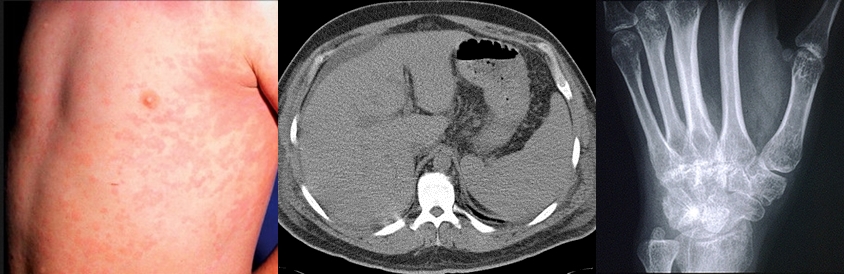 Enfermedad de Still. Síntomas, causas y tratamientos de Enfermedad de ...