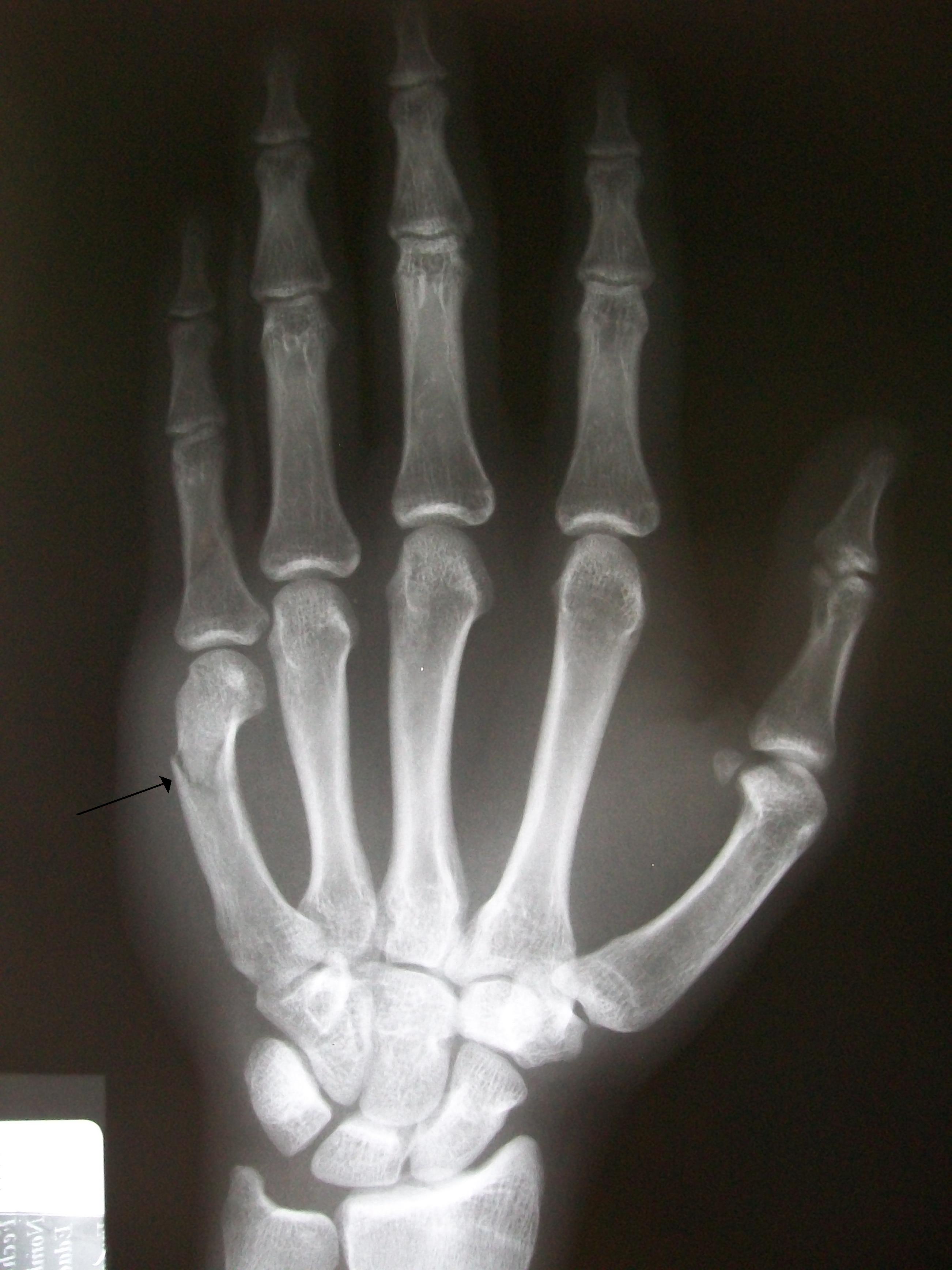 Fractura de mano. Síntomas, causas y tratamientos de Fractura de mano ...